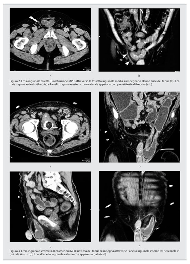 Strutture Del Canale Inguinale